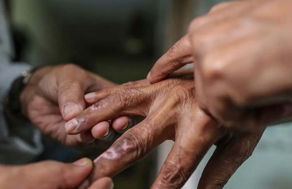 Lepra, una enfermedad curable que sigue siendo estigmatizada - PressLibre